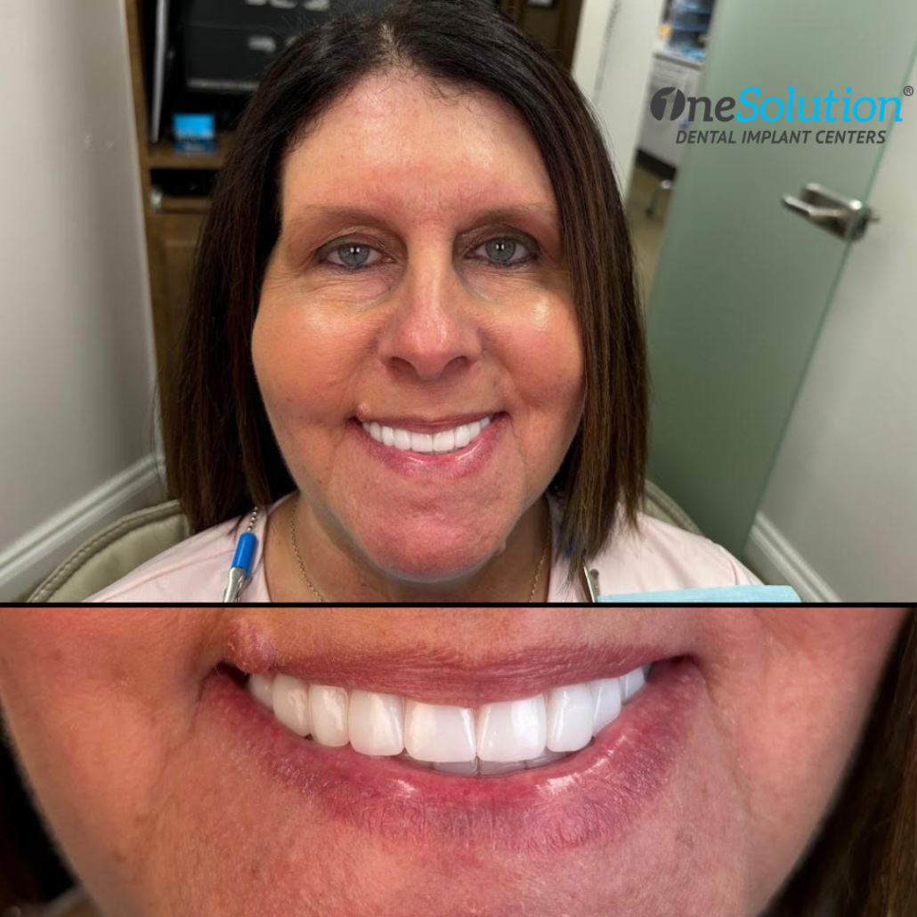 Zirconia Teeth: The Ultimate Guide in 2024 | OneSolution®